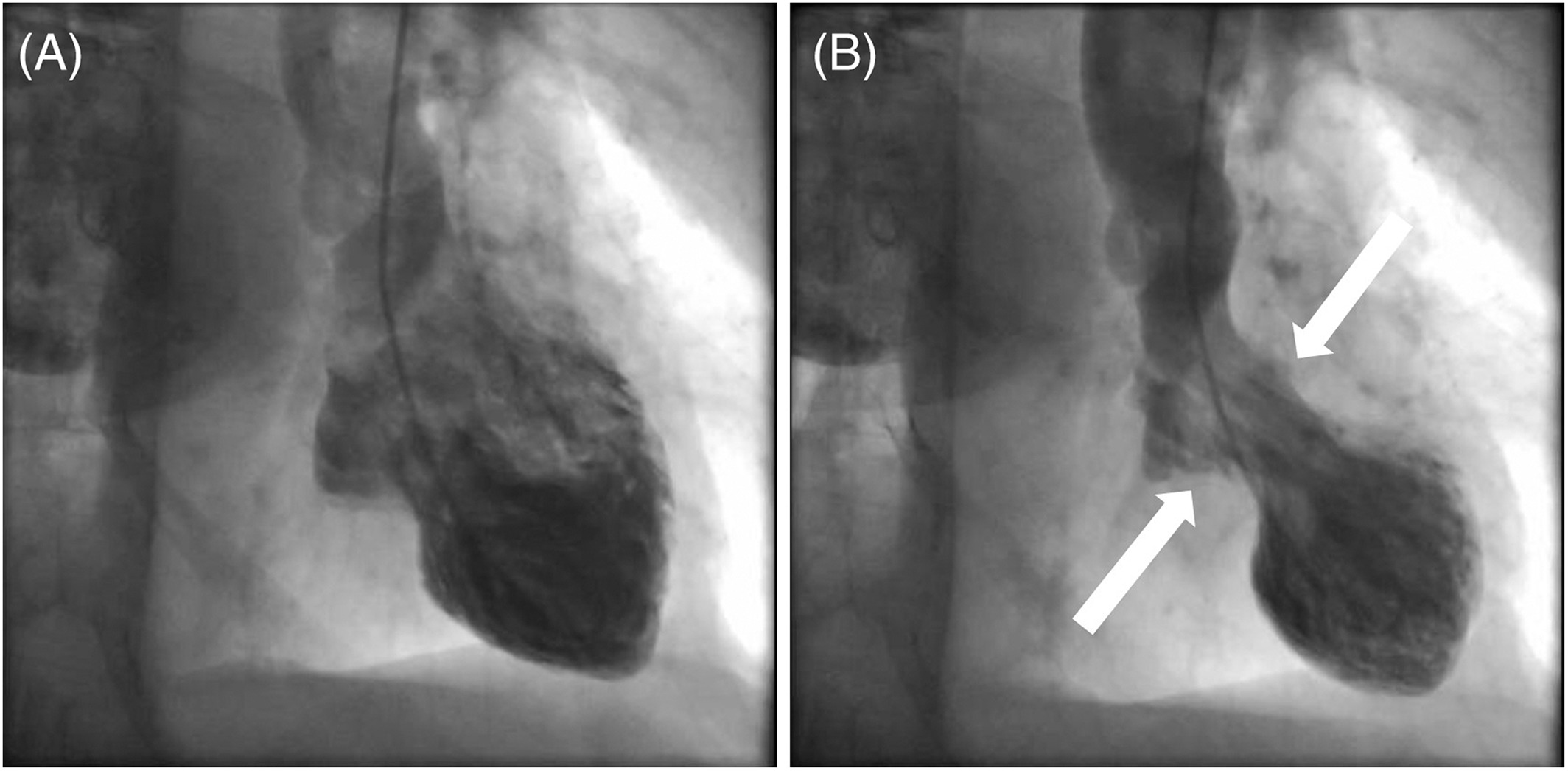 How to identify broken heart syndrome Life - HUM News