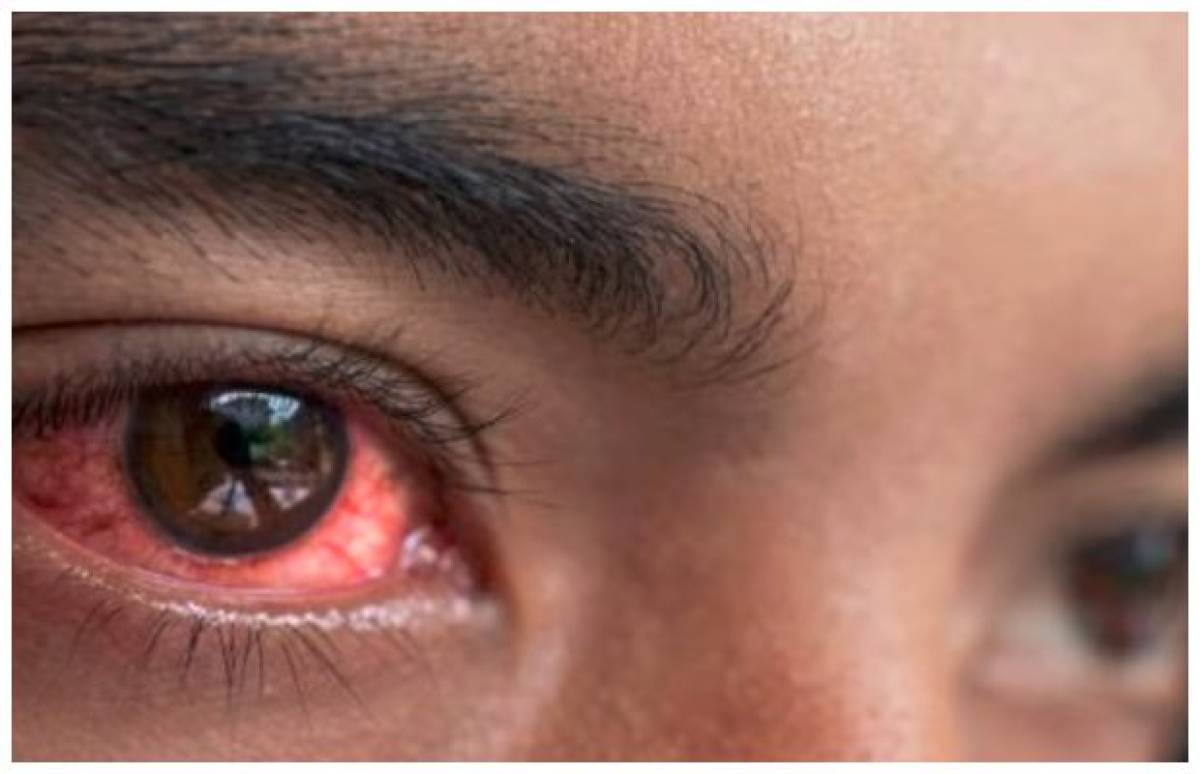 Lahore grapples with pink eye outbreak Latest - HUM News