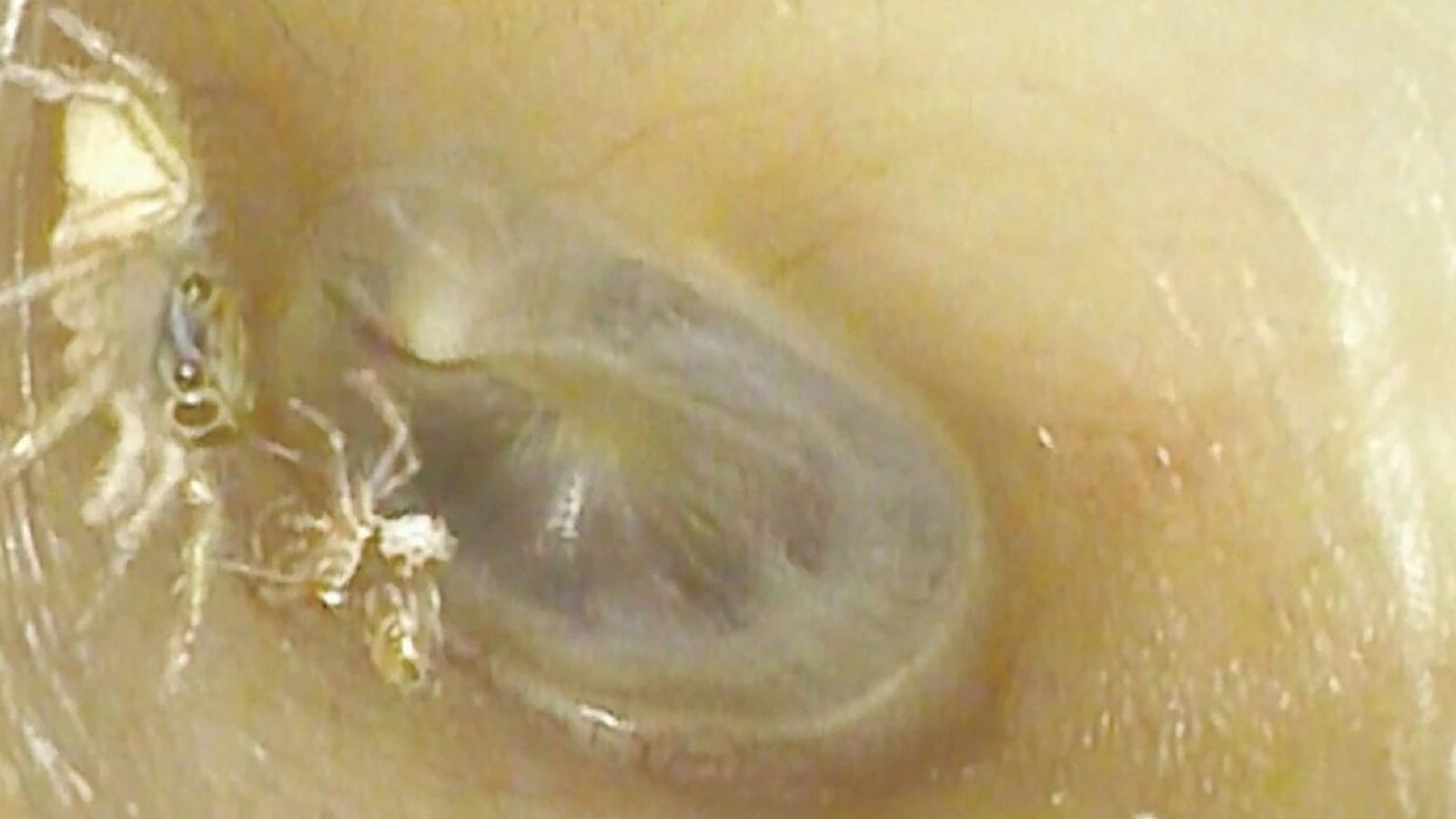 'Ear-resistible surprise': spider found in woman's ear - HUM News